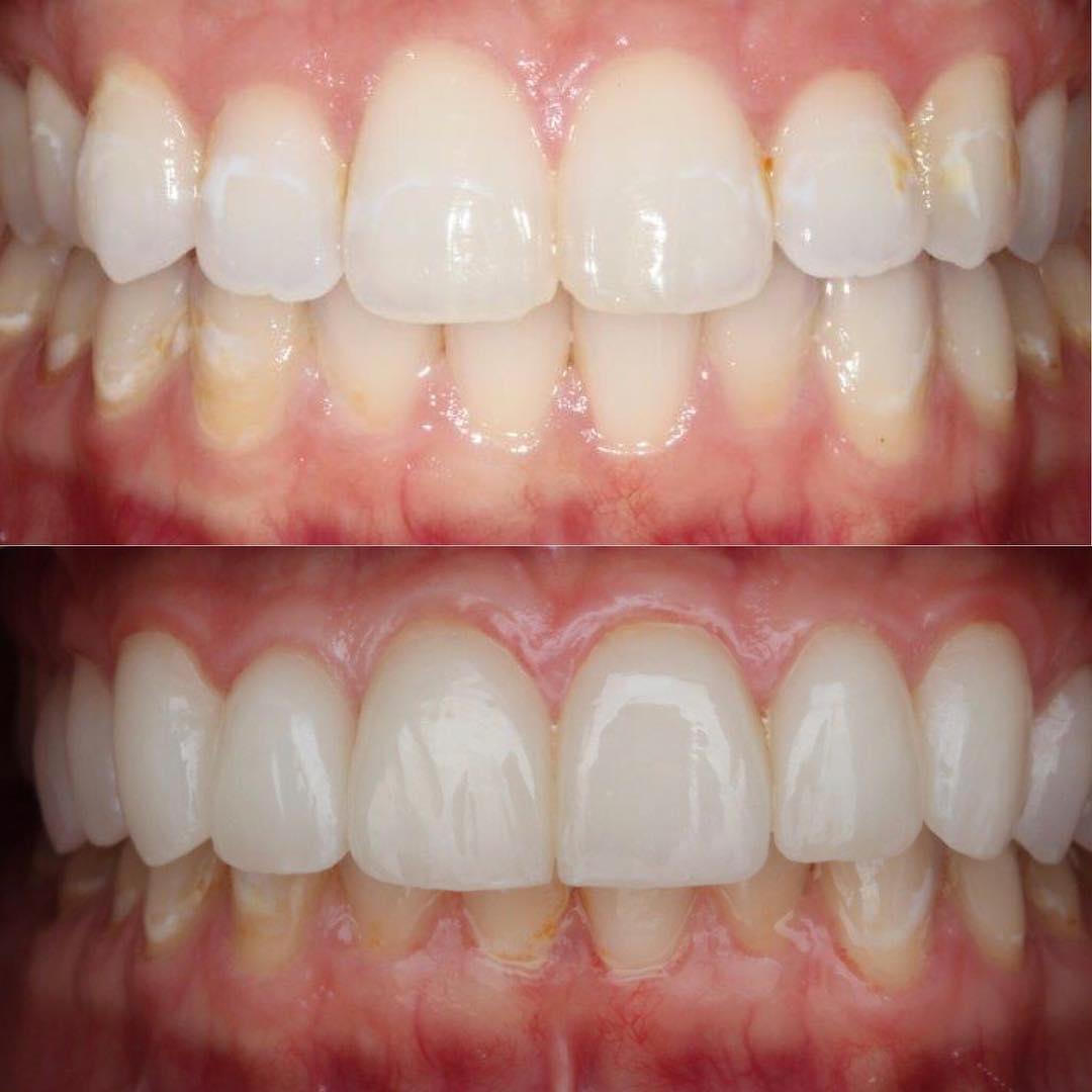 How Can Porcelain Veneers Refresh My Smile Virginia Beach