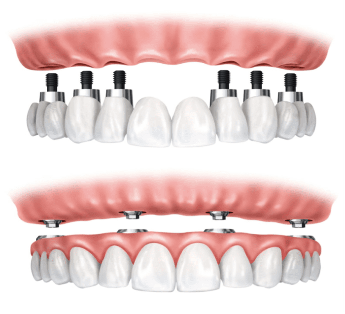 All-On-Four Dentistry: A Comprehensive Guide | Virginia Beach